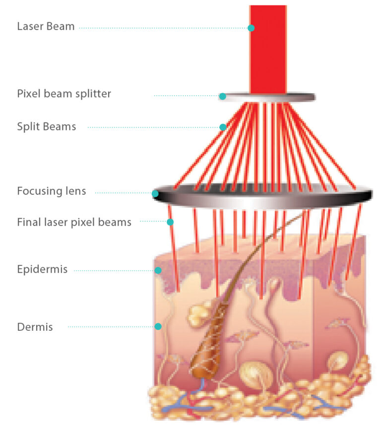 CO2 Laser Skin Resurfacing | Phoenix, AZ | Millennium Laser & Aesthetics