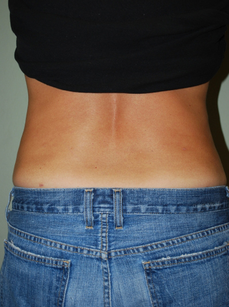 SmartLipo | Millennium Laser & Aesthetics